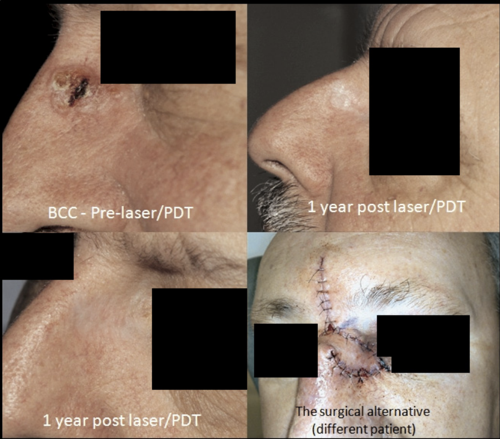 Laser-Assisted PDT for Skin Cancer — The Skin Doctor